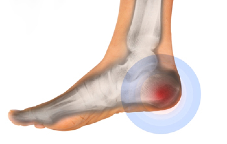 Signs and Treatment of a Fractured Heel